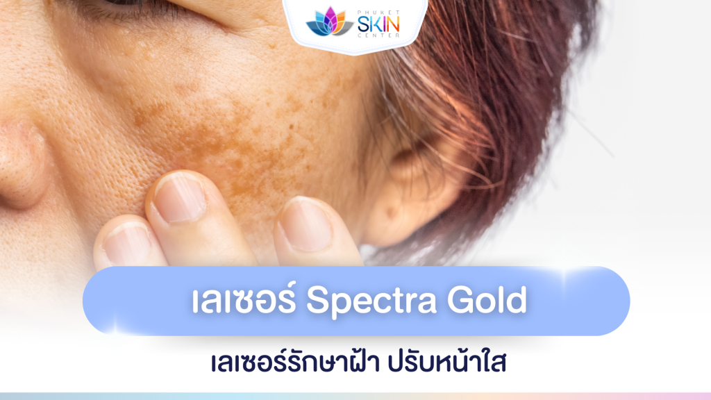 Spectra Gold เลเซอร์รักษาฝ้า ปรับหน้าใส
