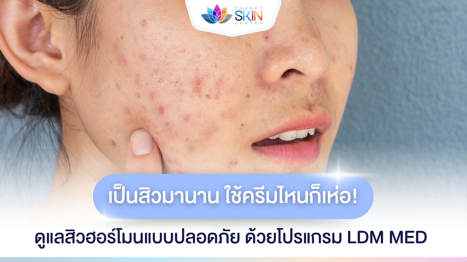 เป็นสิวมานาน ใช้ครีมไหนก็เห่อ! ดูแลสิวฮอร์โมนแบบปลอดภัย ด้วยโปรแกรม LDM MED