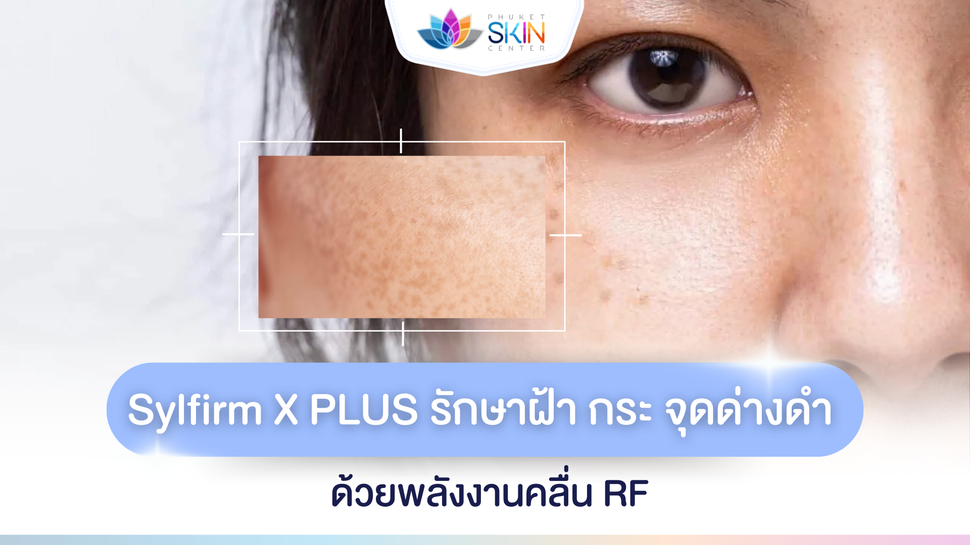 Sylfirm X PLUS รักษาฝ้า กระ จุดด่างดำ ด้วยพลังงานคลื่น RF